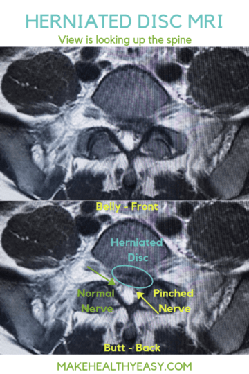 herniated disc mri picture - Make Healthy Easy - Jenna Braddock RD